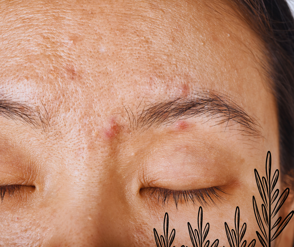 The Ultimate Guide to Clearing Clogged Pores for Good